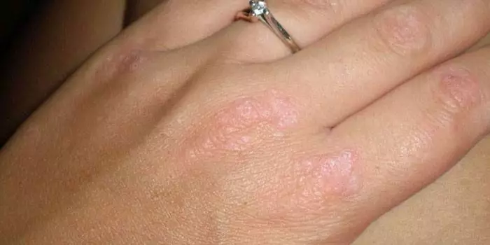 Manifestimi i psoriasis në lëkurën e duarve të një gruaje