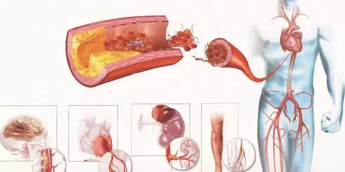 Atherosclerosis ee weelasha xubnaha kala duwan ee aadanaha