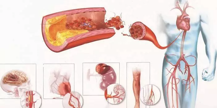 Diagrama de aterosclerose da aorta de varios órganos humanos