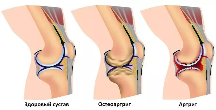 ჯანსაღი მუხლის დიაგრამა და ართრიტის შემდეგ, ოსტეოართრიტი