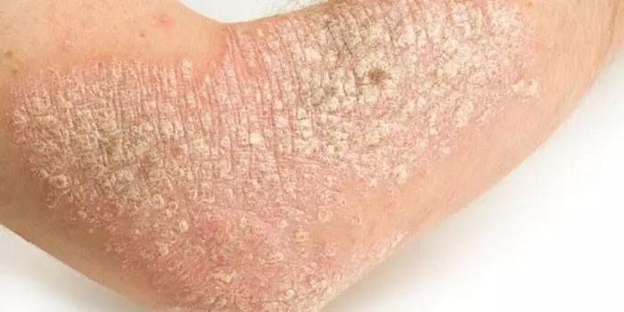Psoriasis pada kulit tangan