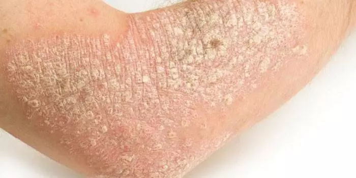 Psoriasis kulusu lwesandla