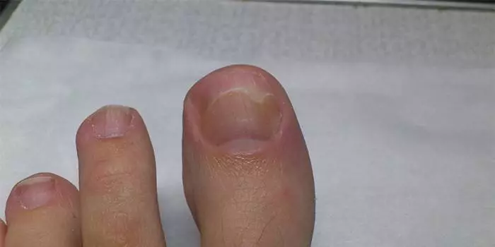 Onycholysis dina toe toe