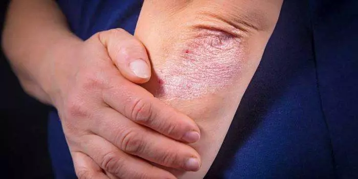 Psoriasis on the elbow of a woman