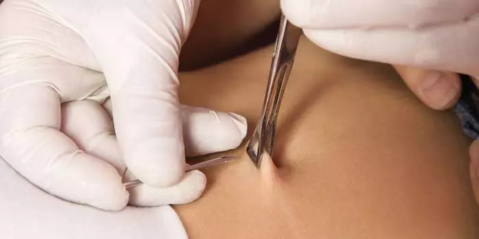 Navel piercing procedure