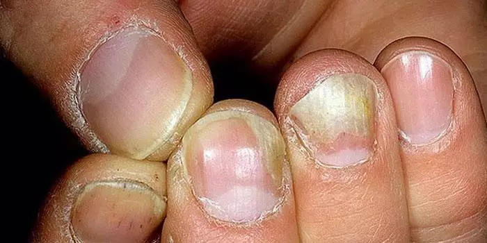 Finger nail fungus