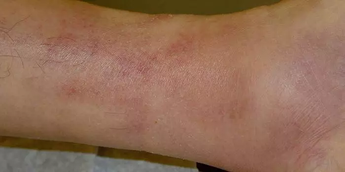 Tromboflebite na perna de um homem