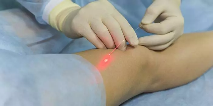 Remoção de veias da perna doentes com laser