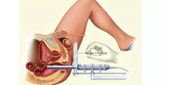 ବ୍ରାଚିଥେରାପି ପ୍ରଣାଳୀ |