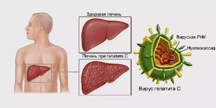 Jetra s hepatitisom C