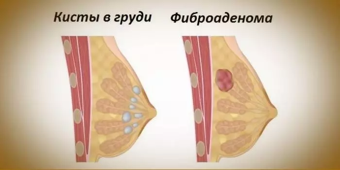 Cyst and fibroadenoma in the breast