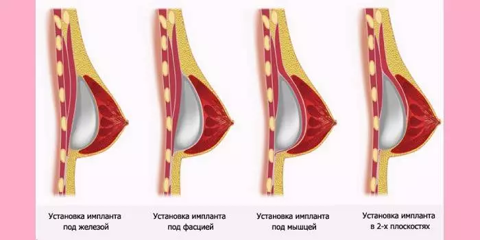 Methods for installing breast implants