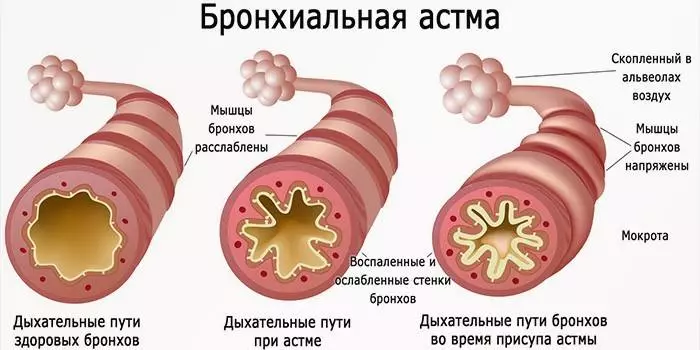 Hutano bronchi, ine bronchial asthma uye panguva yekurwisa