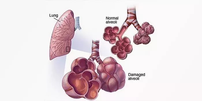 Exogenous allergic alveolitis