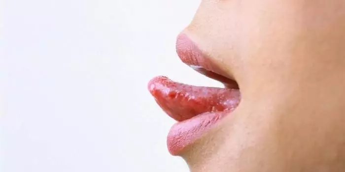 Herpes di lidah - seperti apa, mengapa muncul, gejala dan terapi di rumah