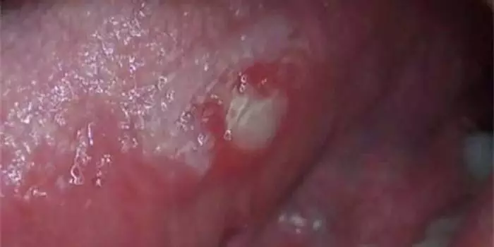 Manifestacija virusa herpesa na jeziku