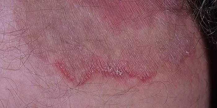 Manifestación de dermatitis del pañal en la ingle de un hombre