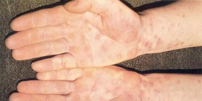 Huiduitslag met syfilis op de huid van de handen