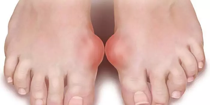 Gout n'ụkwụ