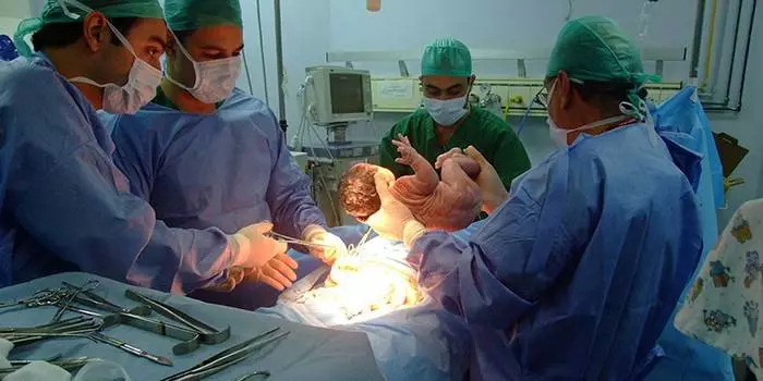 Un equipo de médicos realiza una cesárea.