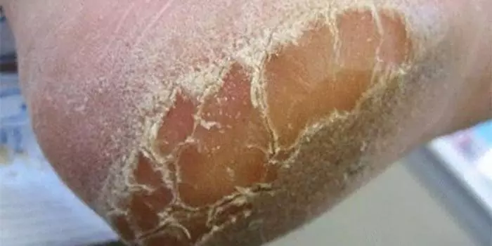 Manifestation of fungus on the human foot