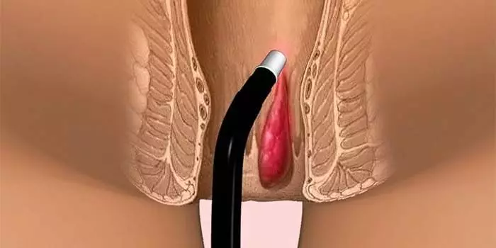 Scheme of infrared coagulation of hemorrhoids