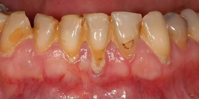 Periodontal disease of the gums