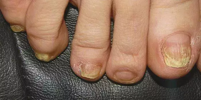 Грибок нігтів пальців ніг