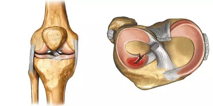 Шикастани meniscus зону - аввалин аломатҳо, аломатҳо, ҷарроҳӣ ва табобати машқ