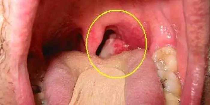 Early stage throat cancer symptoms