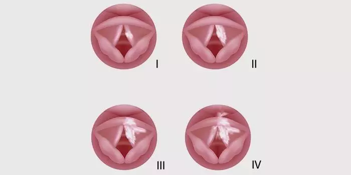 Throat cancer stages