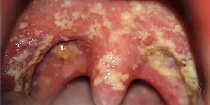 انساني laryngeal candidiasis