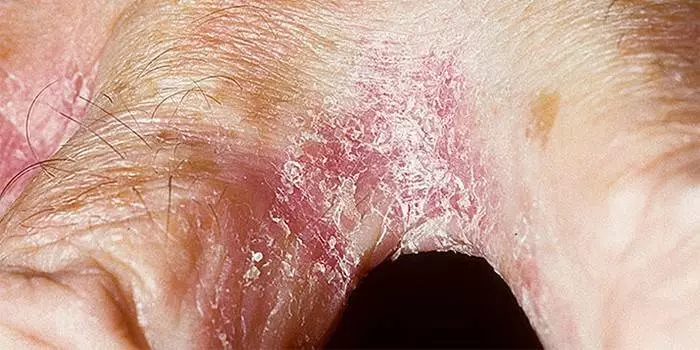 Candidiasis an chraiceann idir na méara