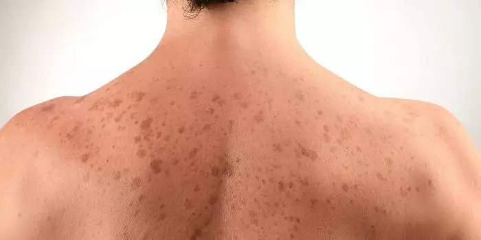 Pityriasis كۆپ خىل رەڭ