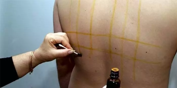 女性が男性の背中にヨウ素ネットを塗る