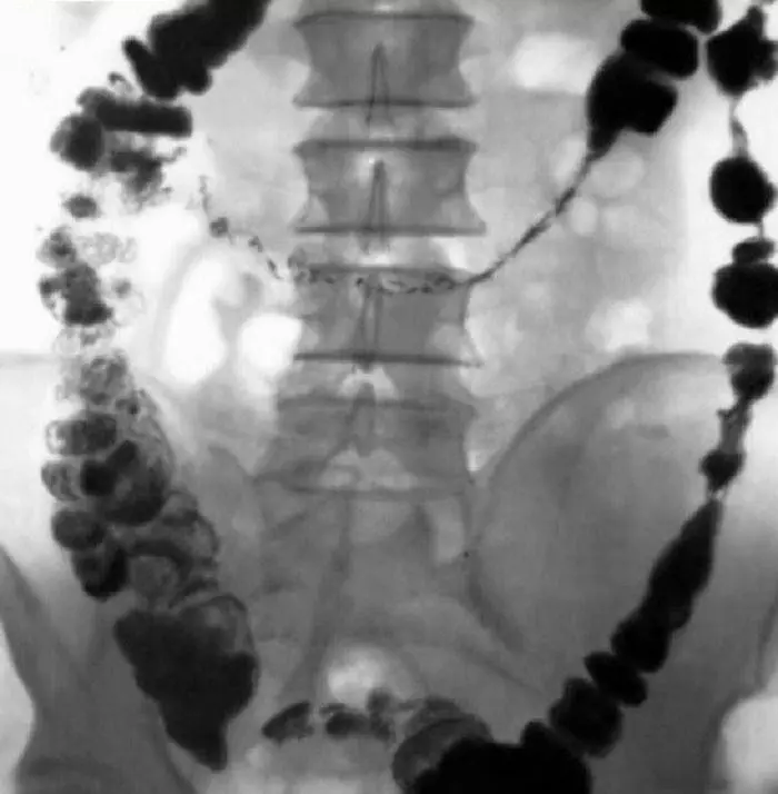 Estreñimiento en las radiografías