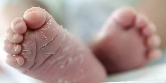 Skallende hud på fødderne af en nyfødt