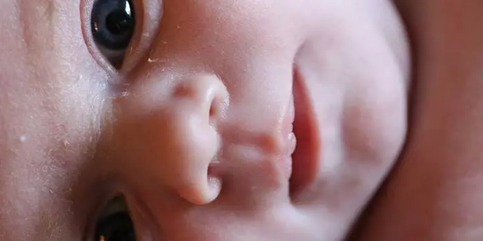 Qërimi i lëkurës në fytyrën e një fëmije