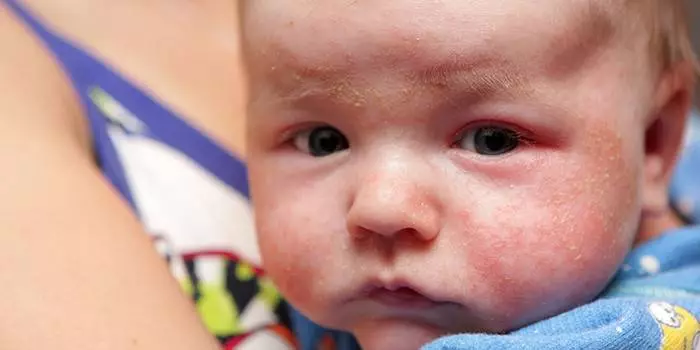 Dermatite no rosto de uma criança