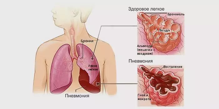 Diagram zdravih pljuč in pljučnice