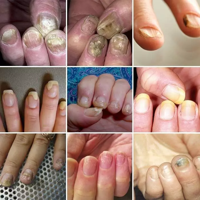 Wéi gesäit den Nagelpilz aus?