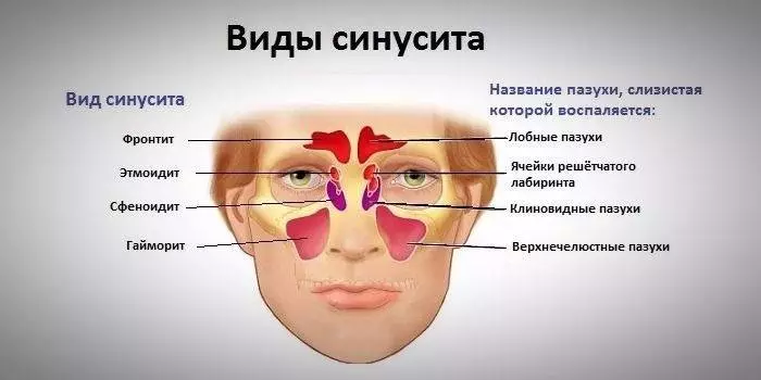 Vrste sinusitisa