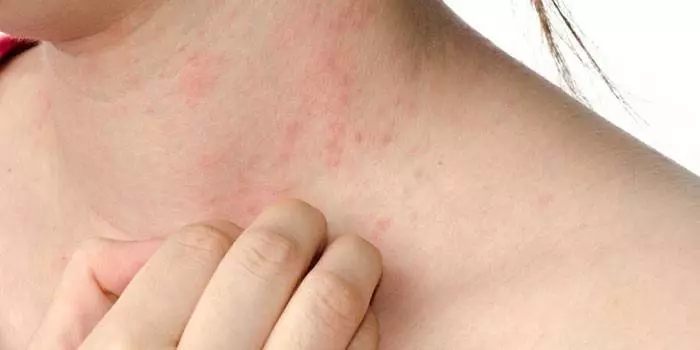 Urticaria en el cuello