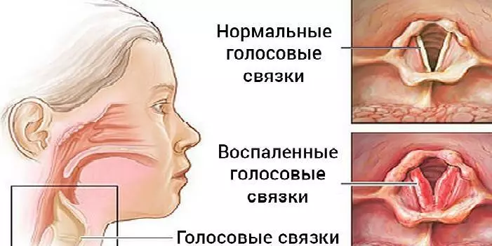 Inflamação dos ligamentos