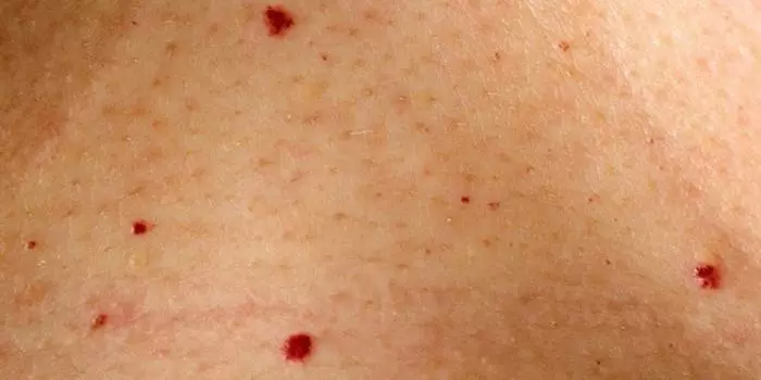 Nốt ruồi đỏ trên cơ thể