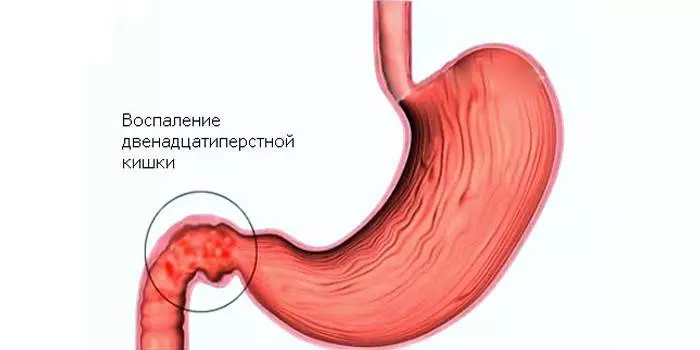 Diagrama do bulbo estomacal