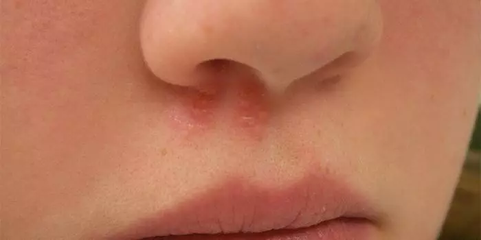 Herpes di hidung anak