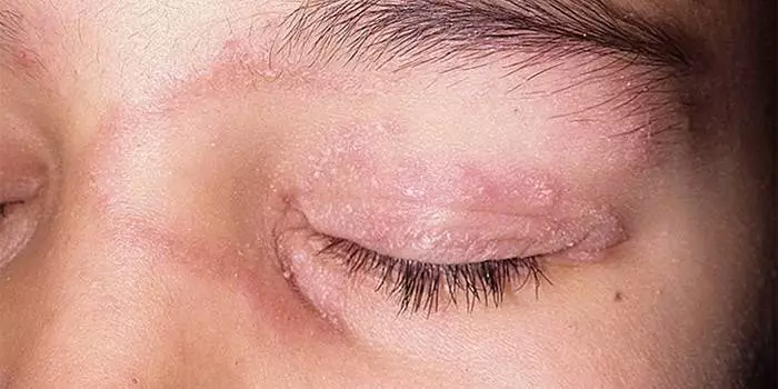 Mycosis pada kelopak mata seorang gadis