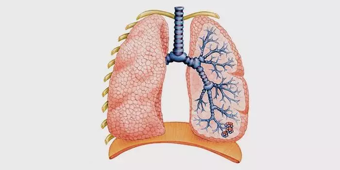 ריאה, חולה COPD