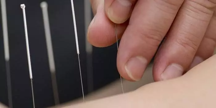 Acupunctuur procedure